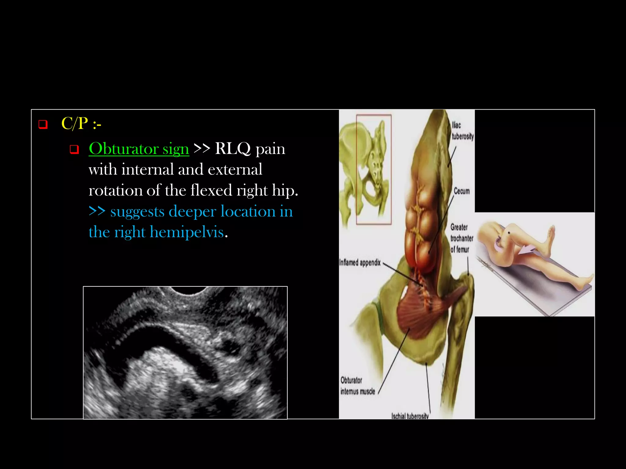 Emergency Ultrasound Course -Lecture 04 -Acute Appendicitis -Part 1 | PDF