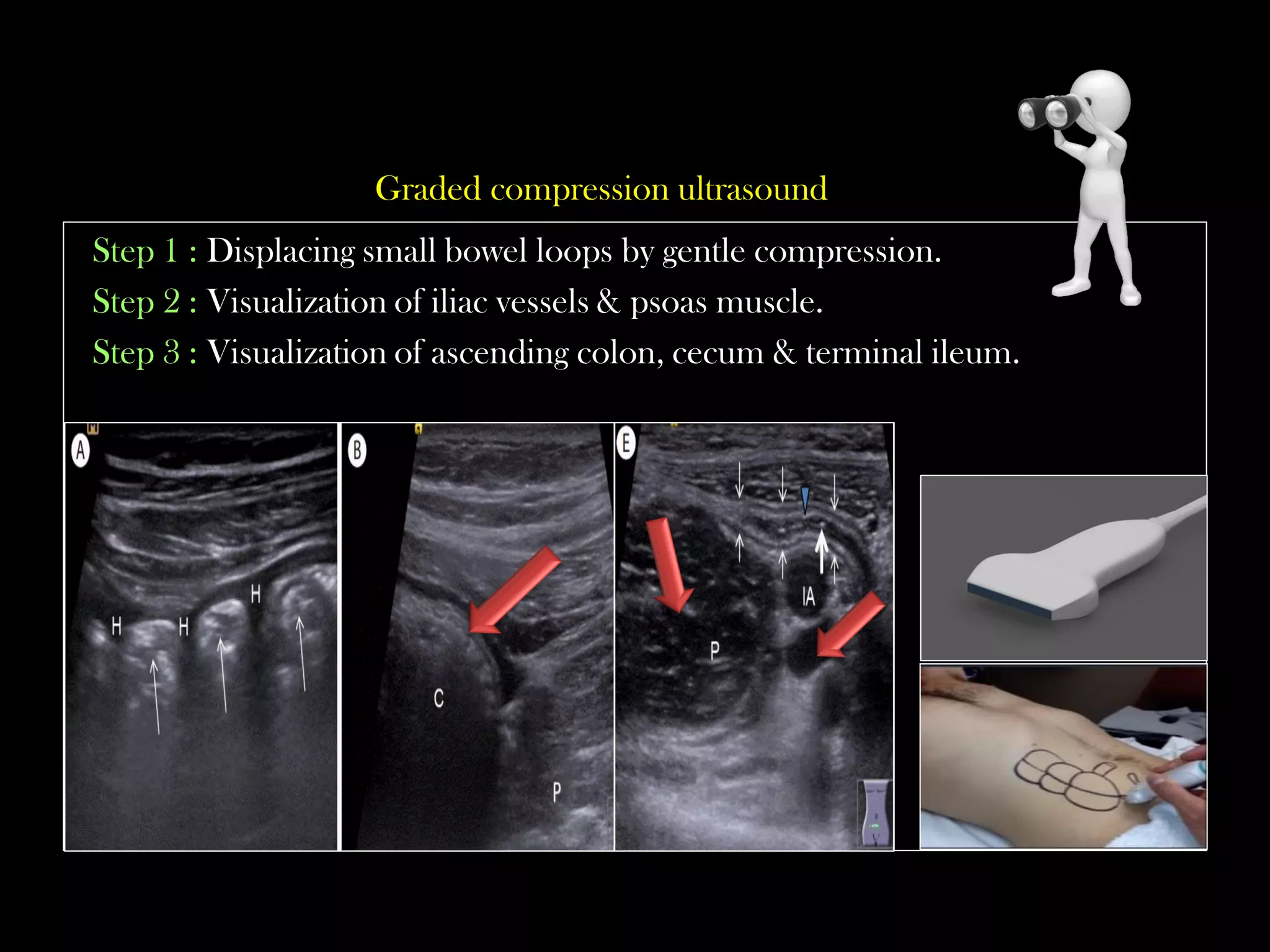 Emergency Ultrasound Course -Lecture 04 -Acute Appendicitis -Part 1 | PDF
