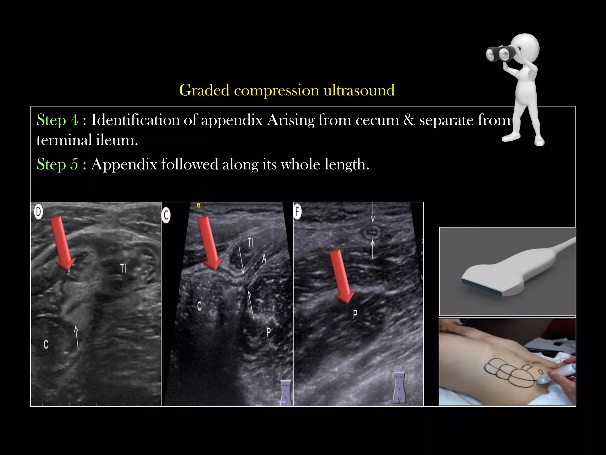Emergency Ultrasound Course -Lecture 04 -Acute Appendicitis -Part 1 | PDF