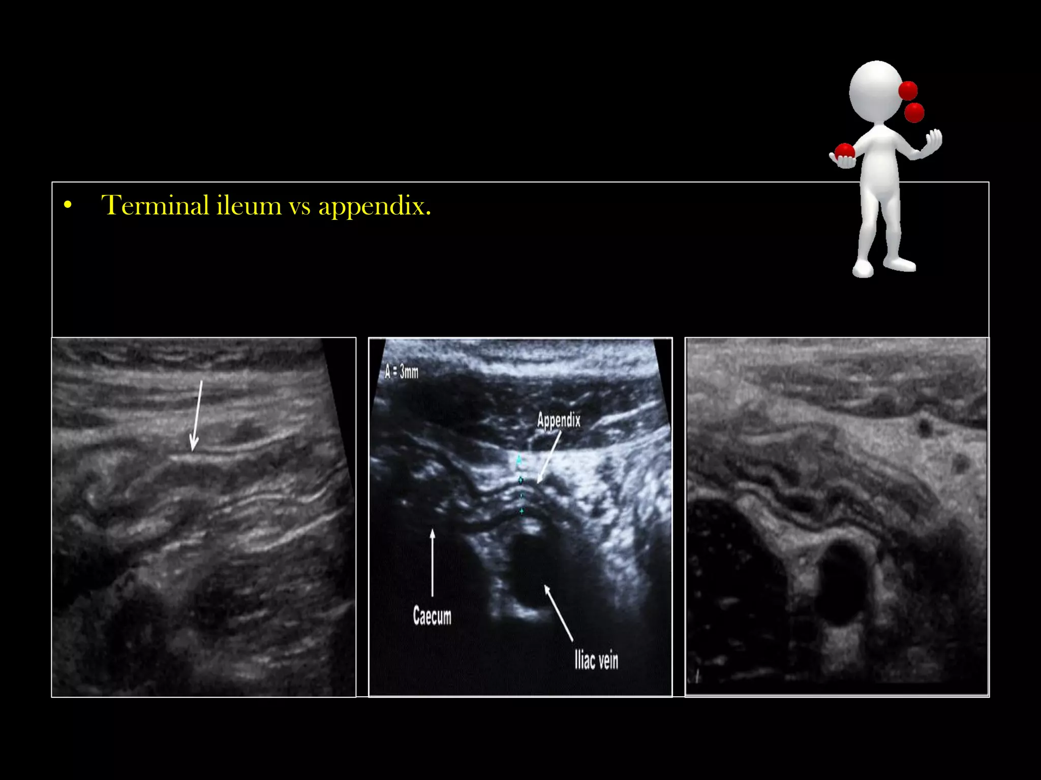 Emergency Ultrasound Course -Lecture 04 -Acute Appendicitis -Part 1 | PDF