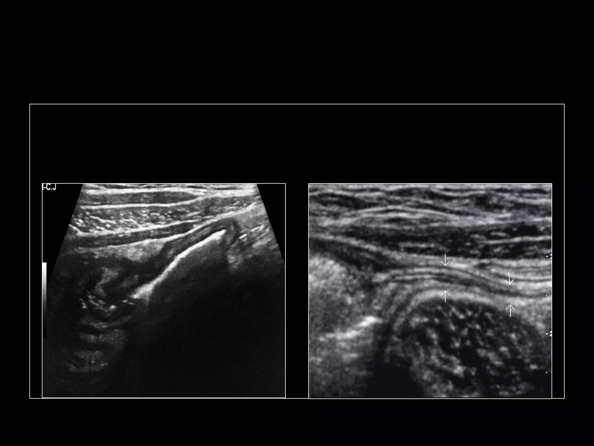 Emergency Ultrasound Course -Lecture 04 -Acute Appendicitis -Part 1 | PDF