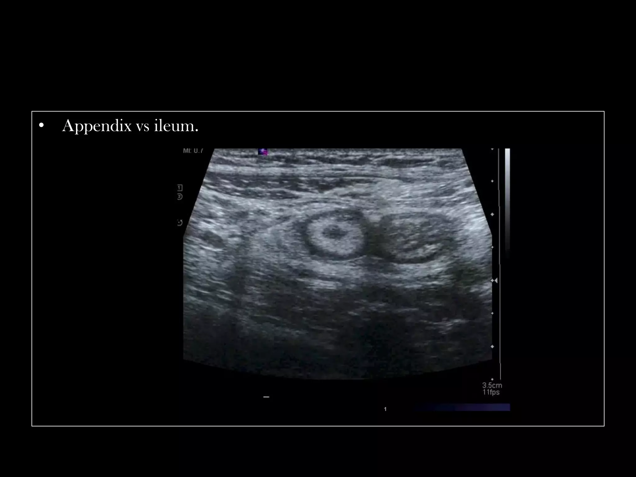 Emergency Ultrasound Course -Lecture 04 -Acute Appendicitis -Part 1 | PDF