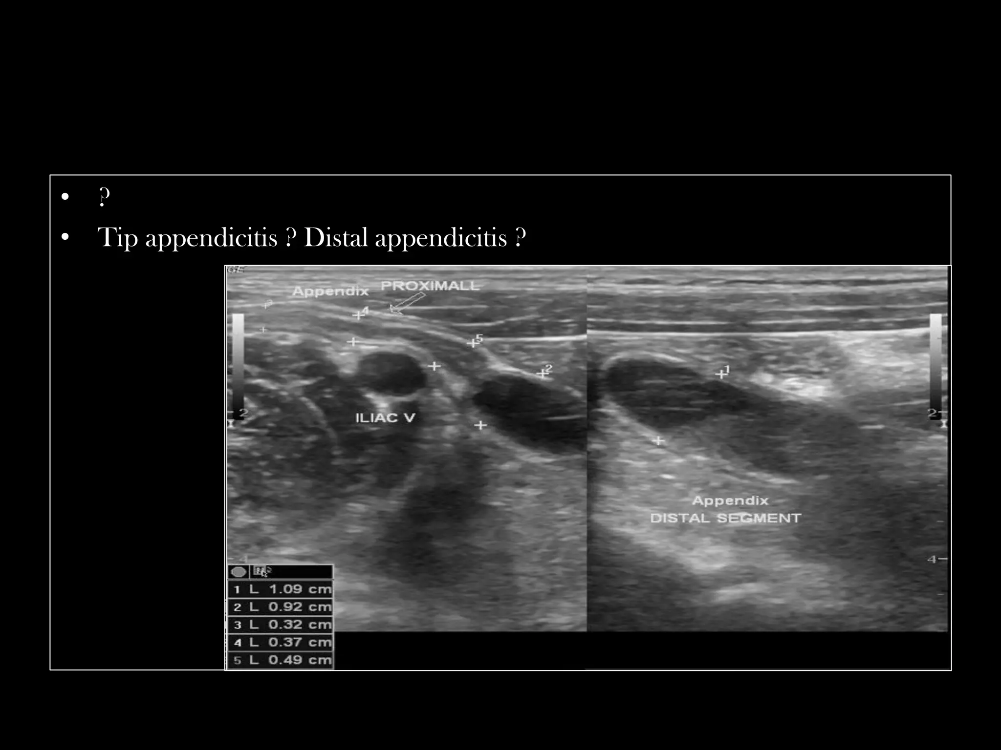 Emergency Ultrasound Course -Lecture 04 -Acute Appendicitis -Part 1 | PDF