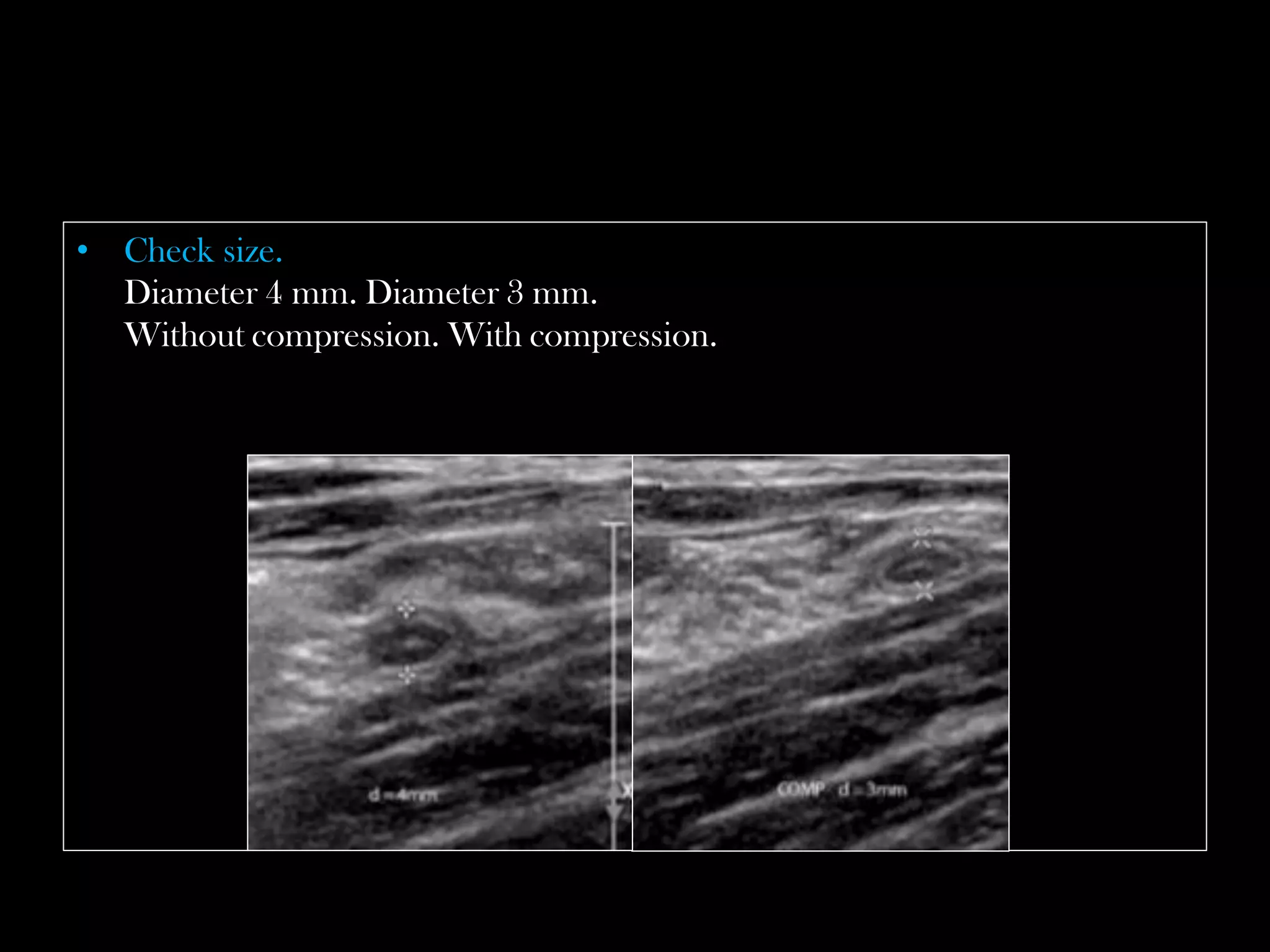 Emergency Ultrasound Course -Lecture 04 -Acute Appendicitis -Part 1 | PDF