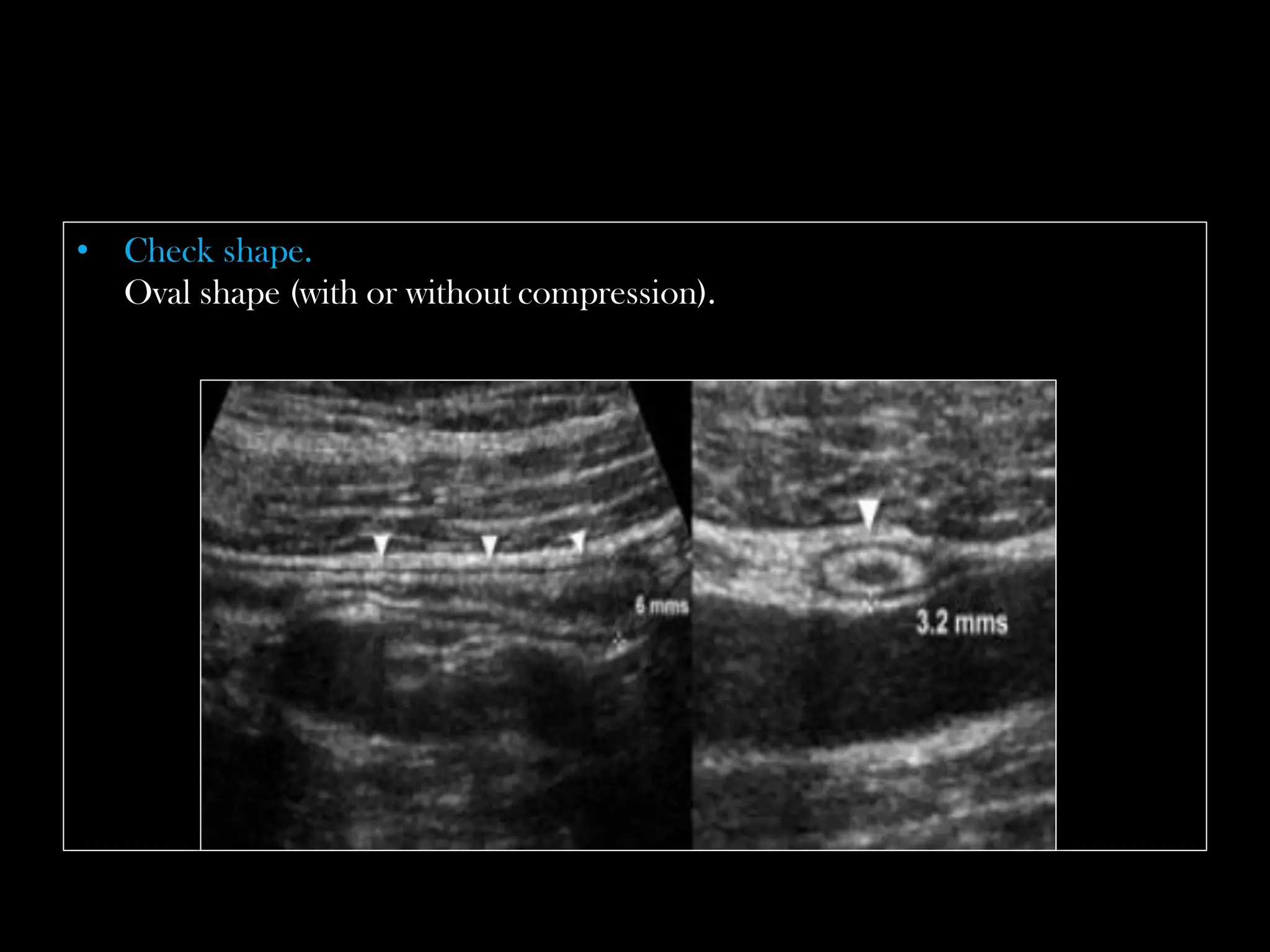 Emergency Ultrasound Course -Lecture 04 -Acute Appendicitis -Part 1 | PDF