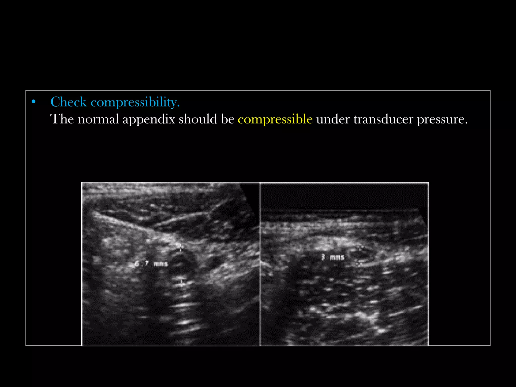 Emergency Ultrasound Course -Lecture 04 -Acute Appendicitis -Part 1 | PDF