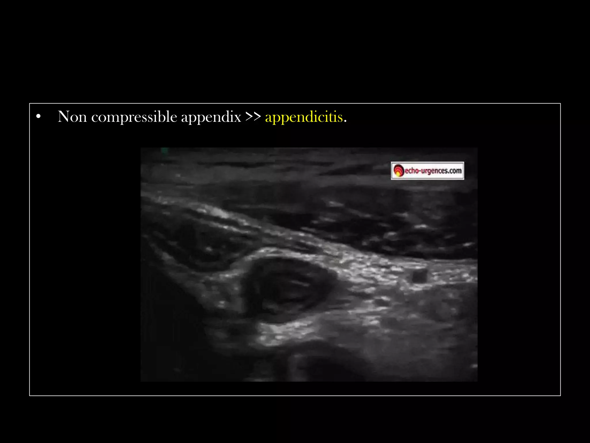 Emergency Ultrasound Course -Lecture 04 -Acute Appendicitis -Part 1 | PDF
