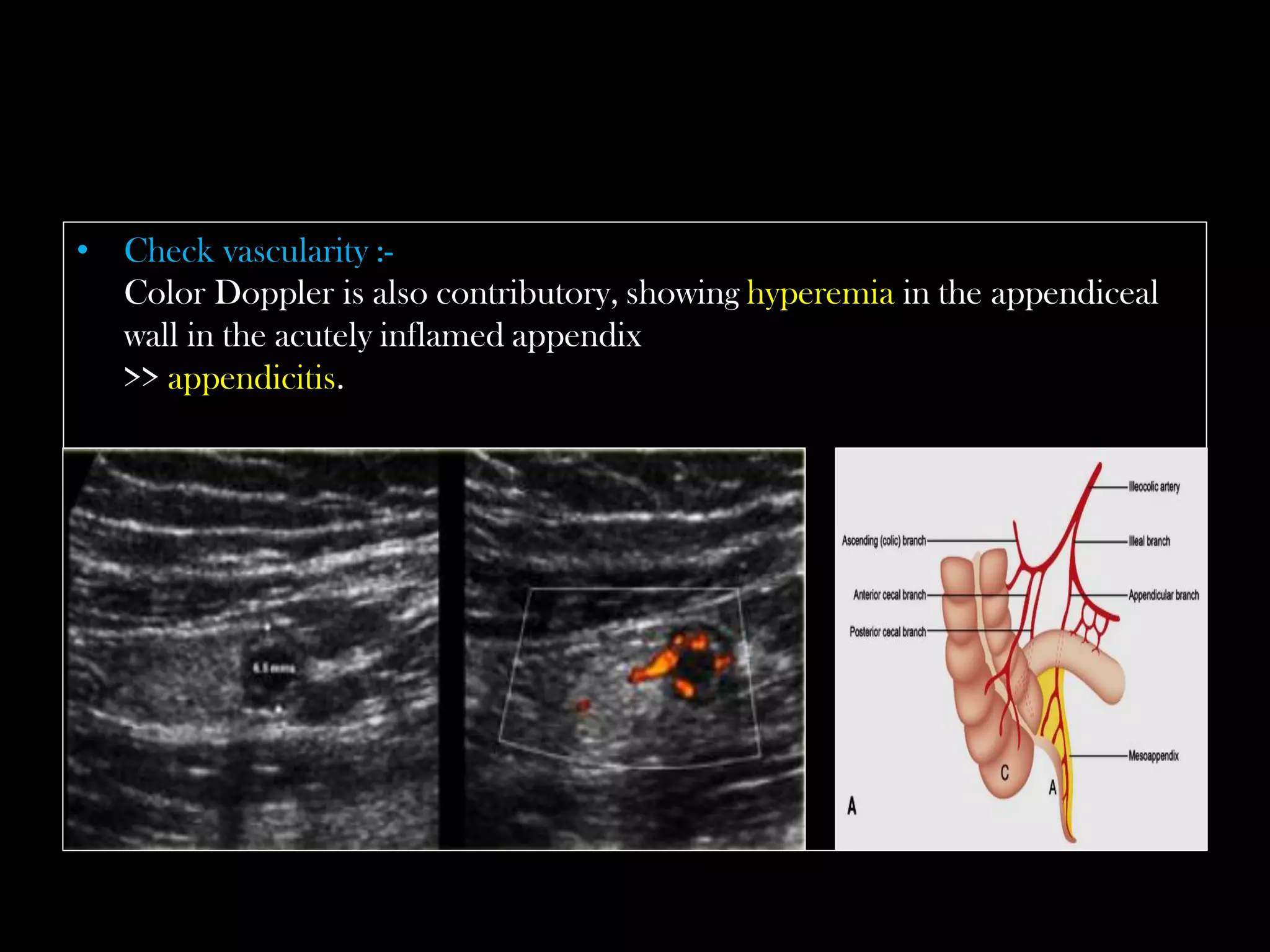 Emergency Ultrasound Course -Lecture 04 -Acute Appendicitis -Part 1 | PDF