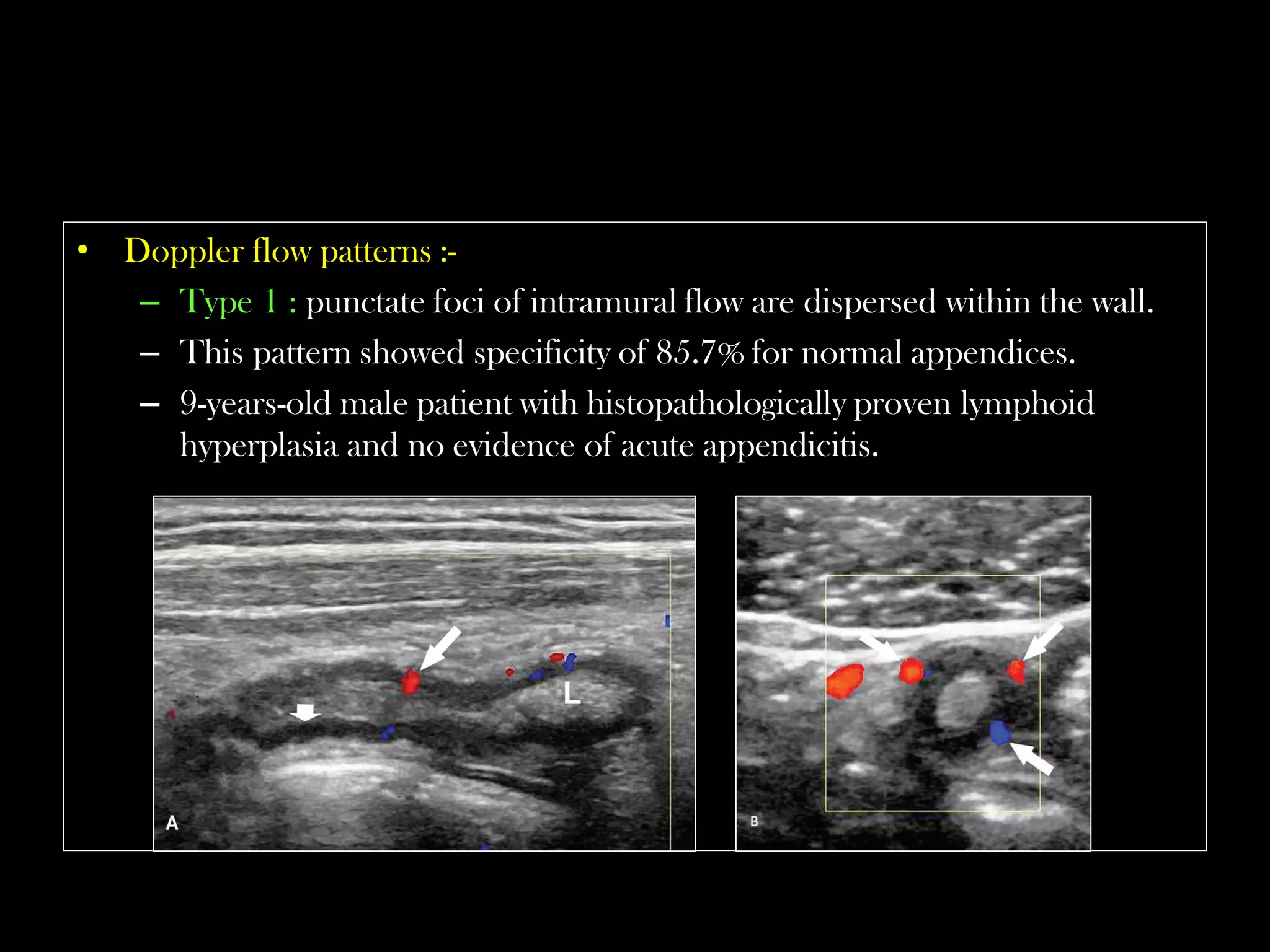 Emergency Ultrasound Course -Lecture 04 -Acute Appendicitis -Part 1 | PDF