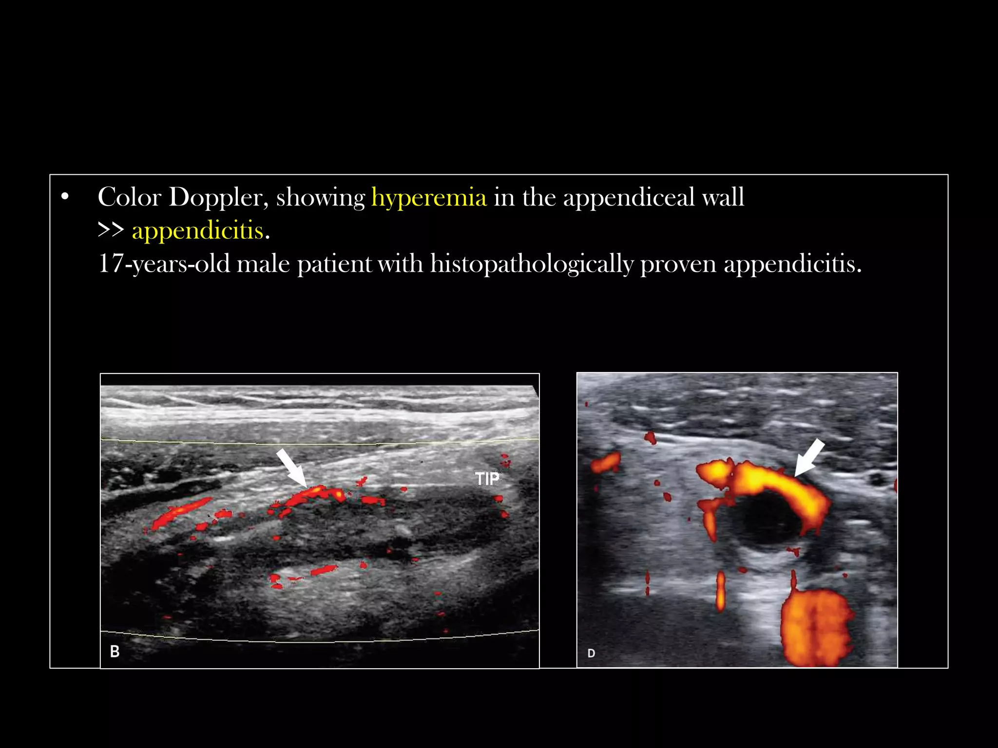 Emergency Ultrasound Course -Lecture 04 -Acute Appendicitis -Part 1 | PDF