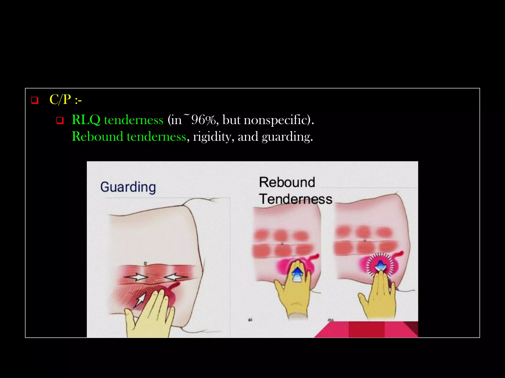 Emergency Ultrasound Course -Lecture 04 -Acute Appendicitis -Part 1 | PDF