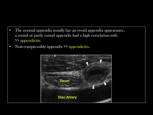 Emergency Ultrasound Course -Lecture 04 -Acute Appendicitis -Part 1 ...