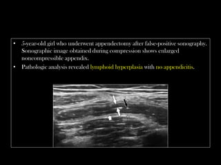 Emergency Ultrasound Course -Lecture 04 -Acute Appendicitis -Part 1 | PDF