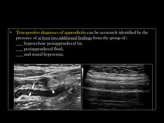 Emergency Ultrasound Course -Lecture 04 -Acute Appendicitis -Part 1 | PDF