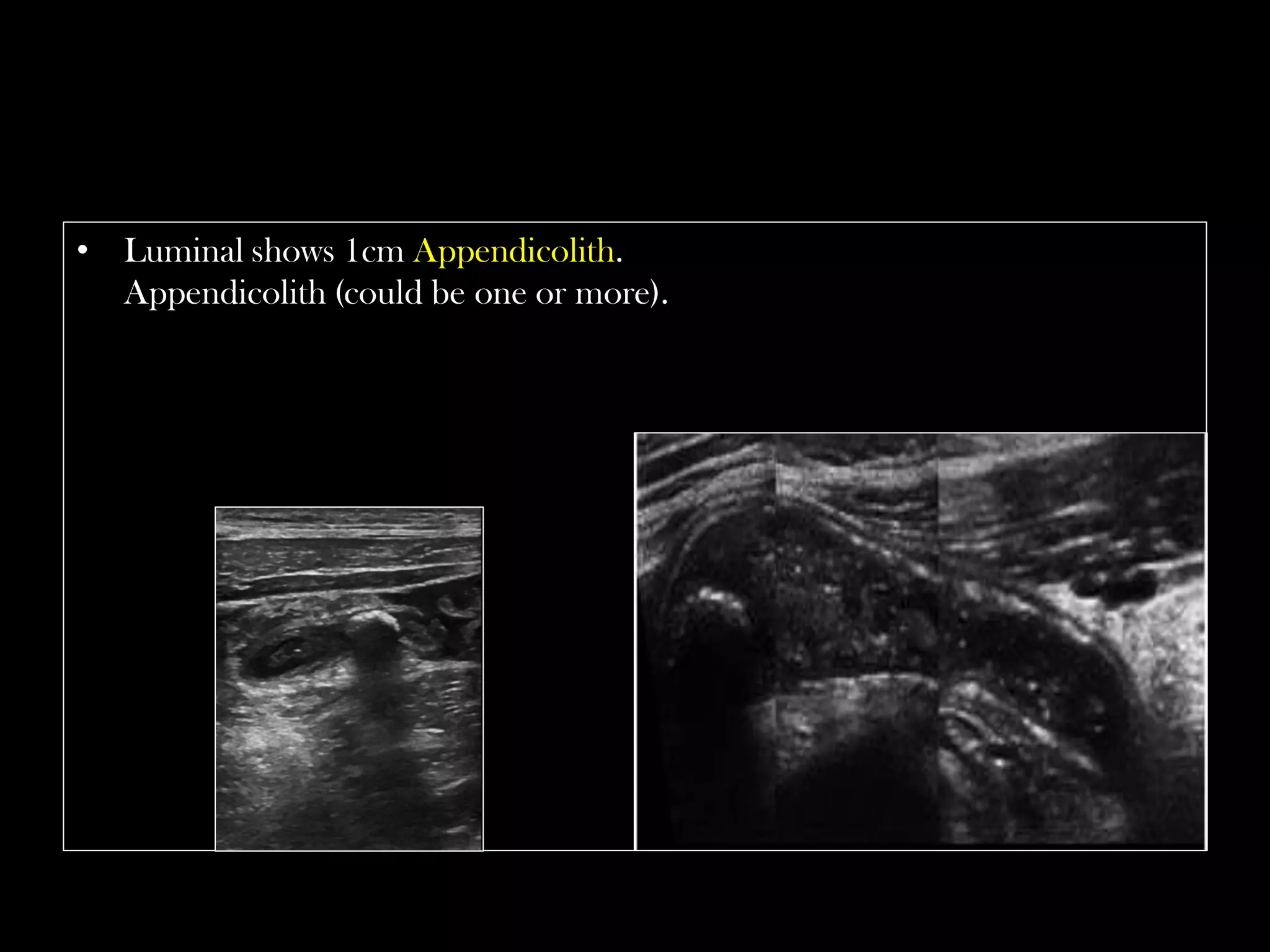 Emergency Ultrasound Course -Lecture 04 -Acute Appendicitis -Part 2 | PDF