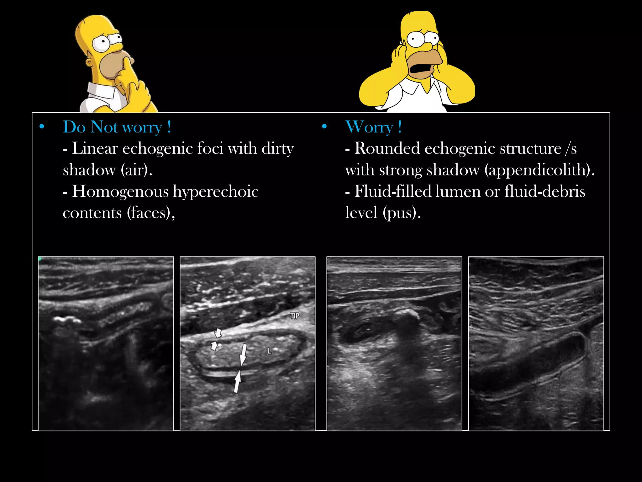Emergency Ultrasound Course -Lecture 04 -Acute Appendicitis -Part 2 | PDF