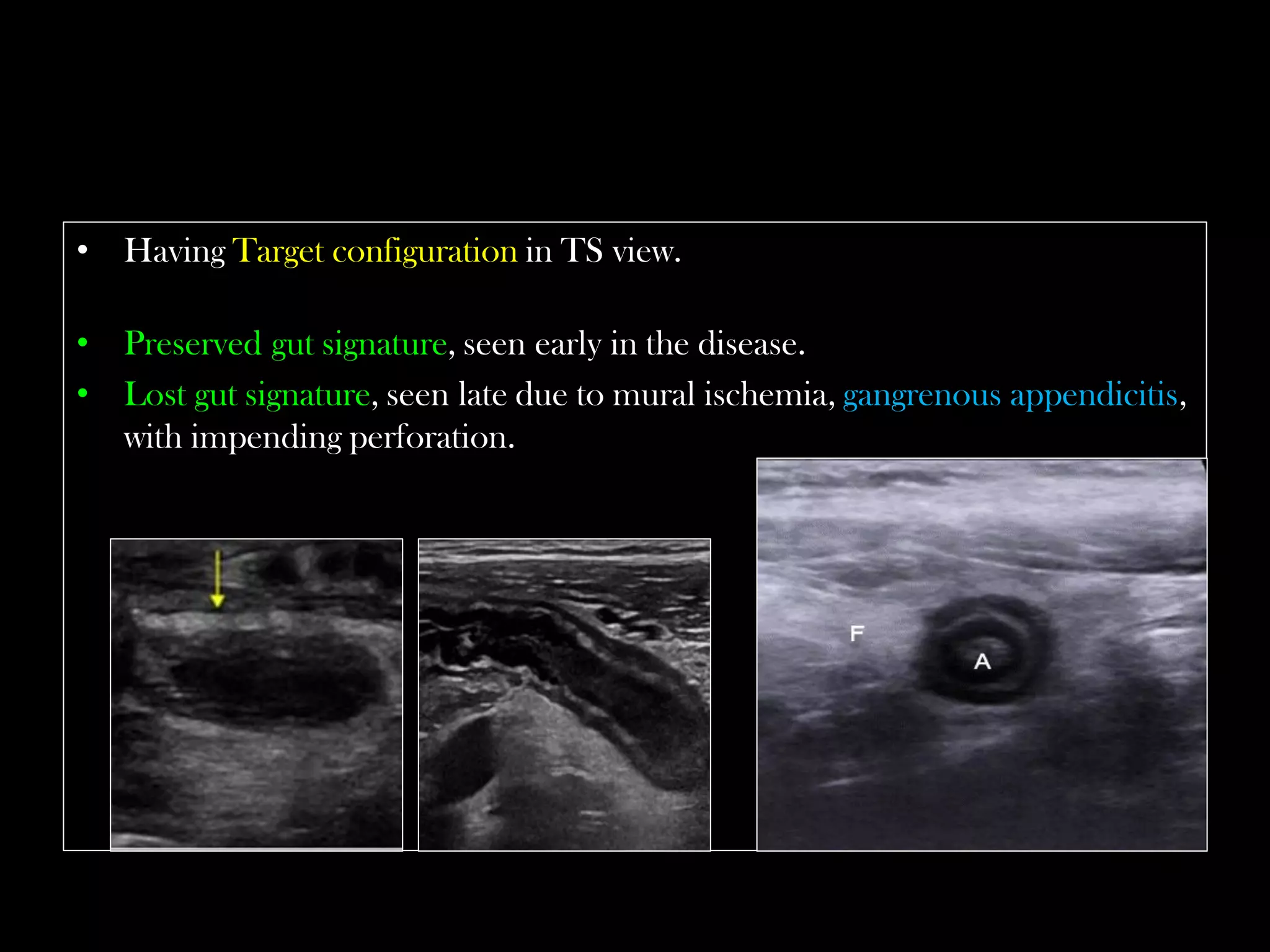 Emergency Ultrasound Course -Lecture 04 -Acute Appendicitis -Part 2 | PDF