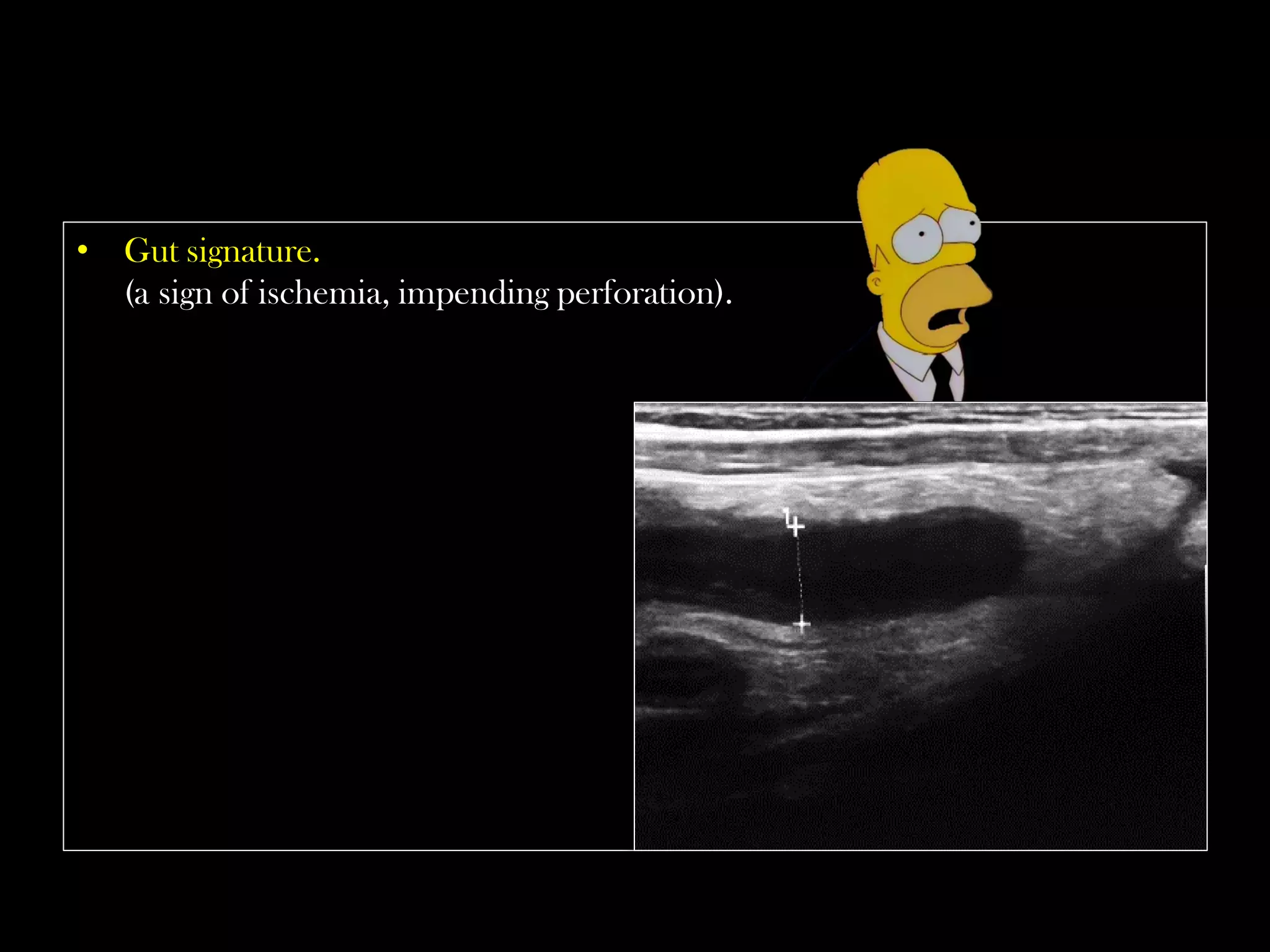 Emergency Ultrasound Course -Lecture 04 -Acute Appendicitis -Part 2 | PDF