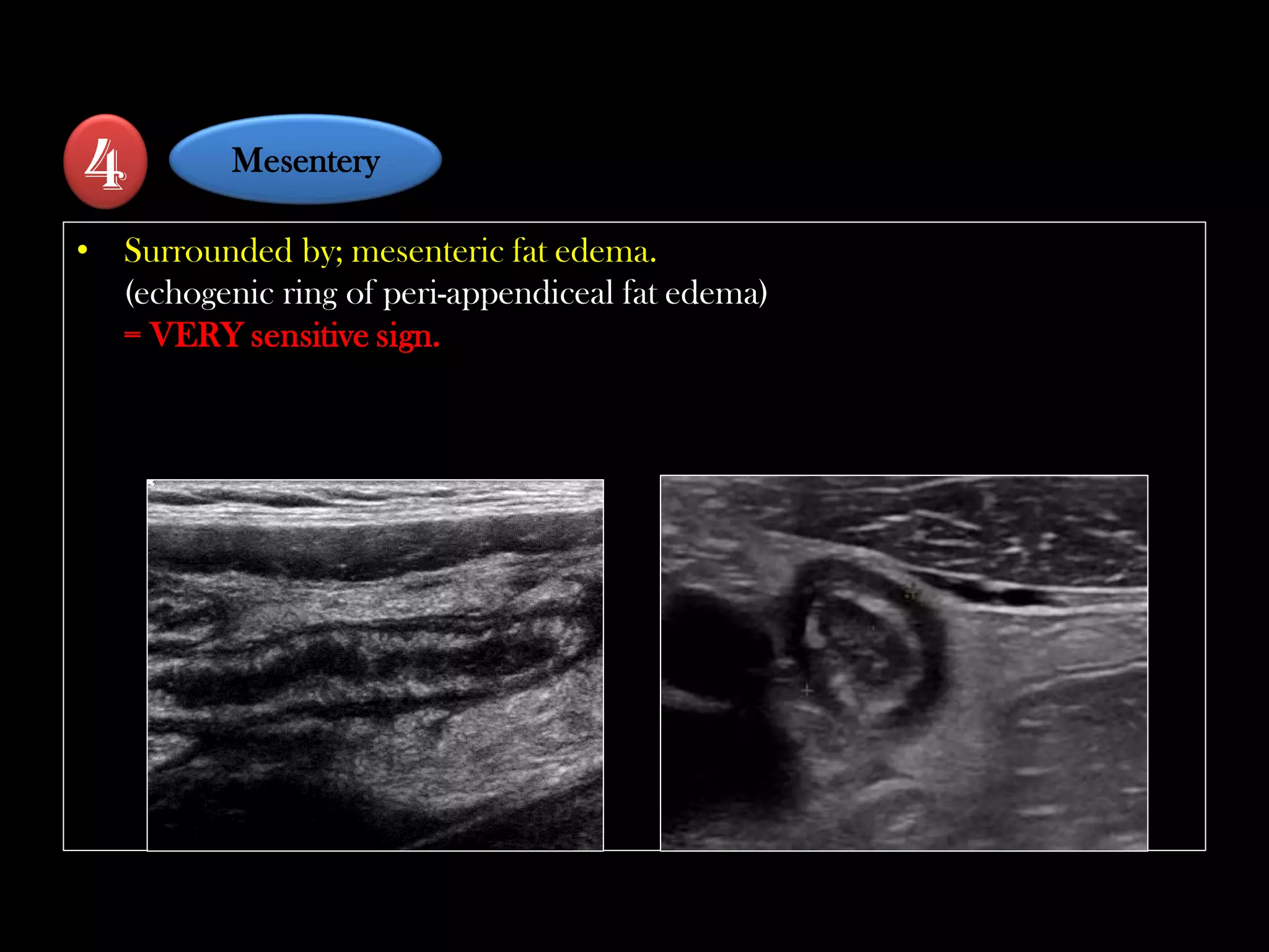 Emergency Ultrasound Course -Lecture 04 -Acute Appendicitis -Part 2 | PDF