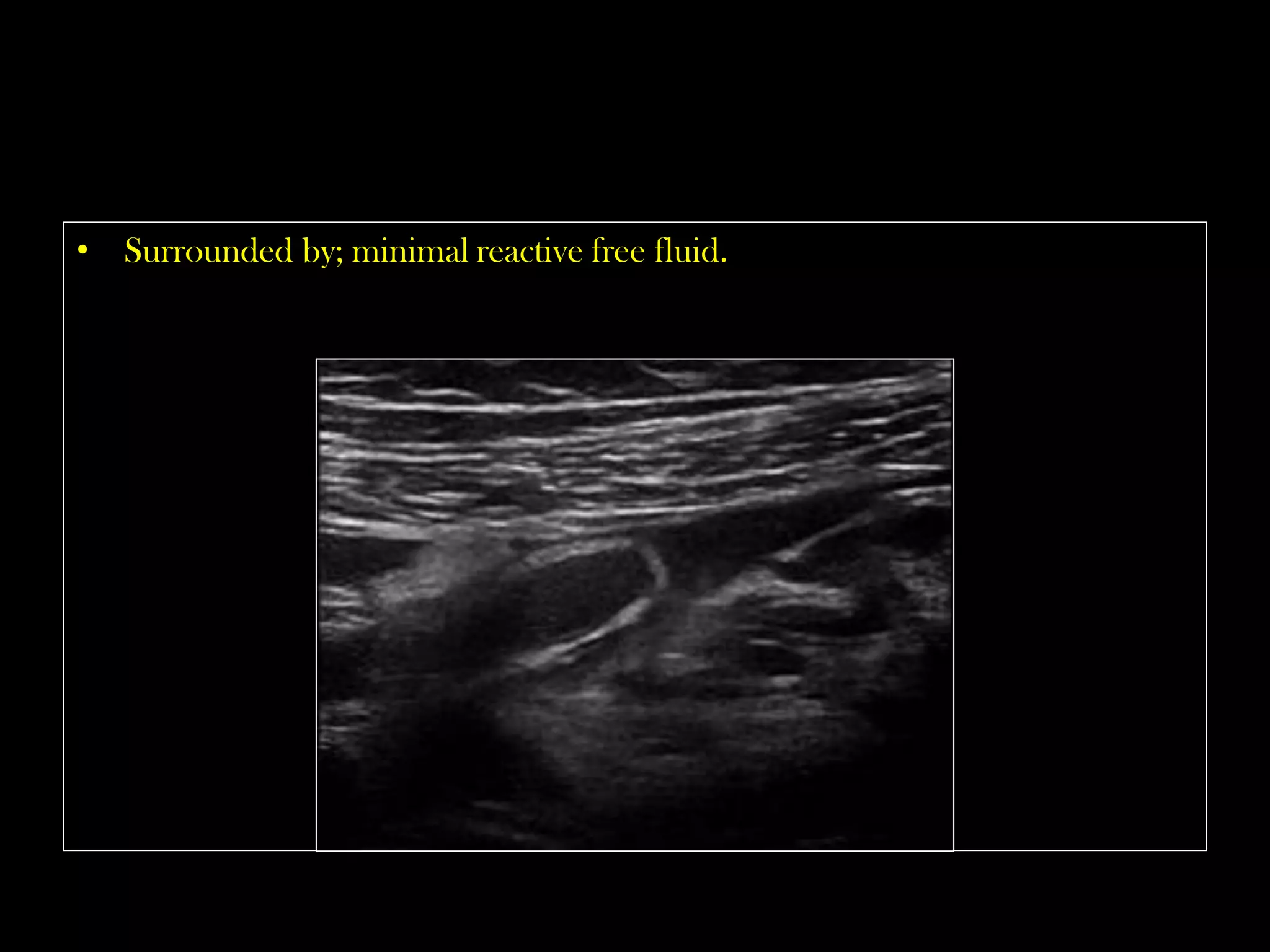 Emergency Ultrasound Course -Lecture 04 -Acute Appendicitis -Part 2 | PDF