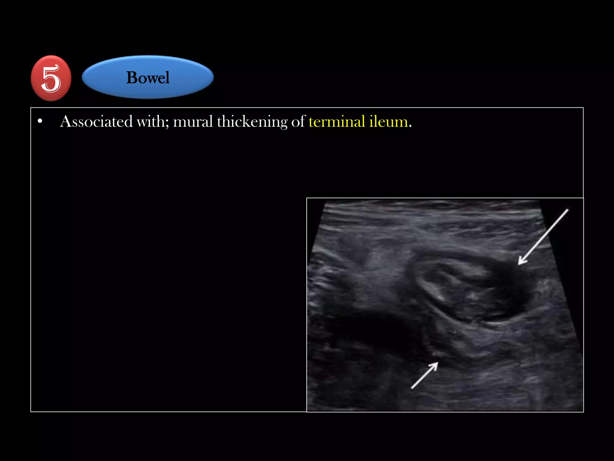 Emergency Ultrasound Course -Lecture 04 -Acute Appendicitis -Part 2 | PDF