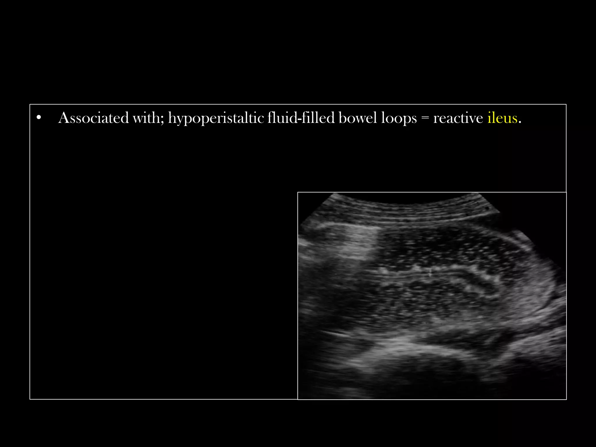 Emergency Ultrasound Course -Lecture 04 -Acute Appendicitis -Part 2 | PDF