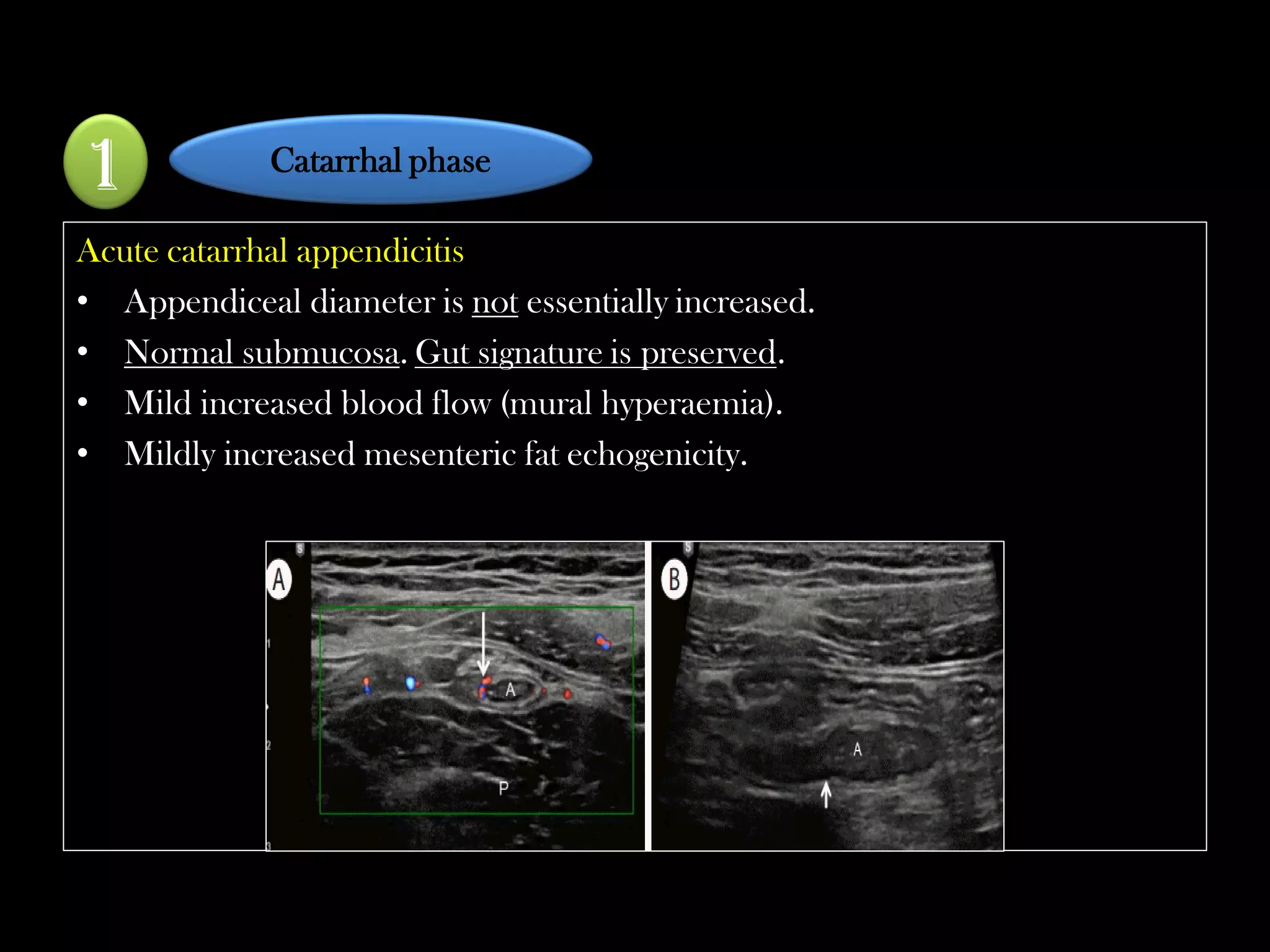 Emergency Ultrasound Course -Lecture 04 -Acute Appendicitis -Part 2 | PDF