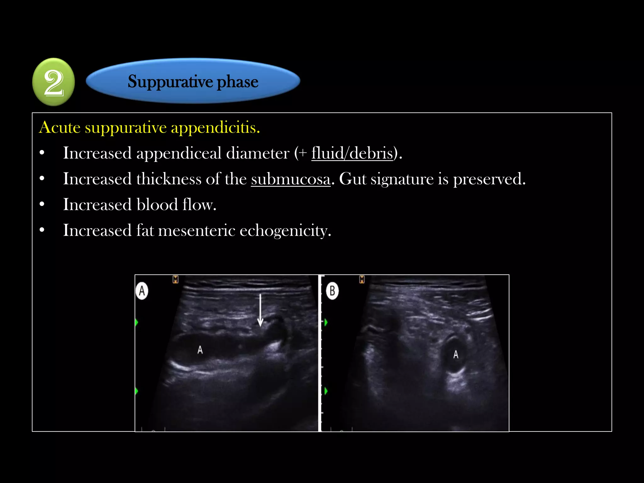 Emergency Ultrasound Course -Lecture 04 -Acute Appendicitis -Part 2 | PDF