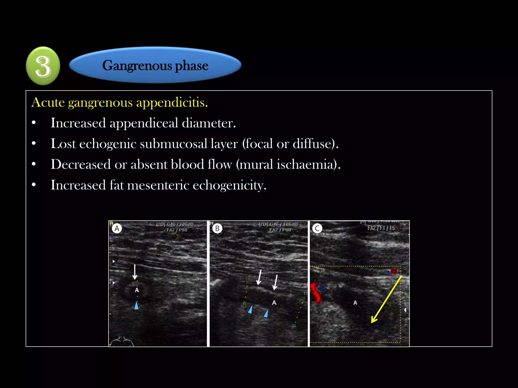 Emergency Ultrasound Course -Lecture 04 -Acute Appendicitis -Part 2 | PDF
