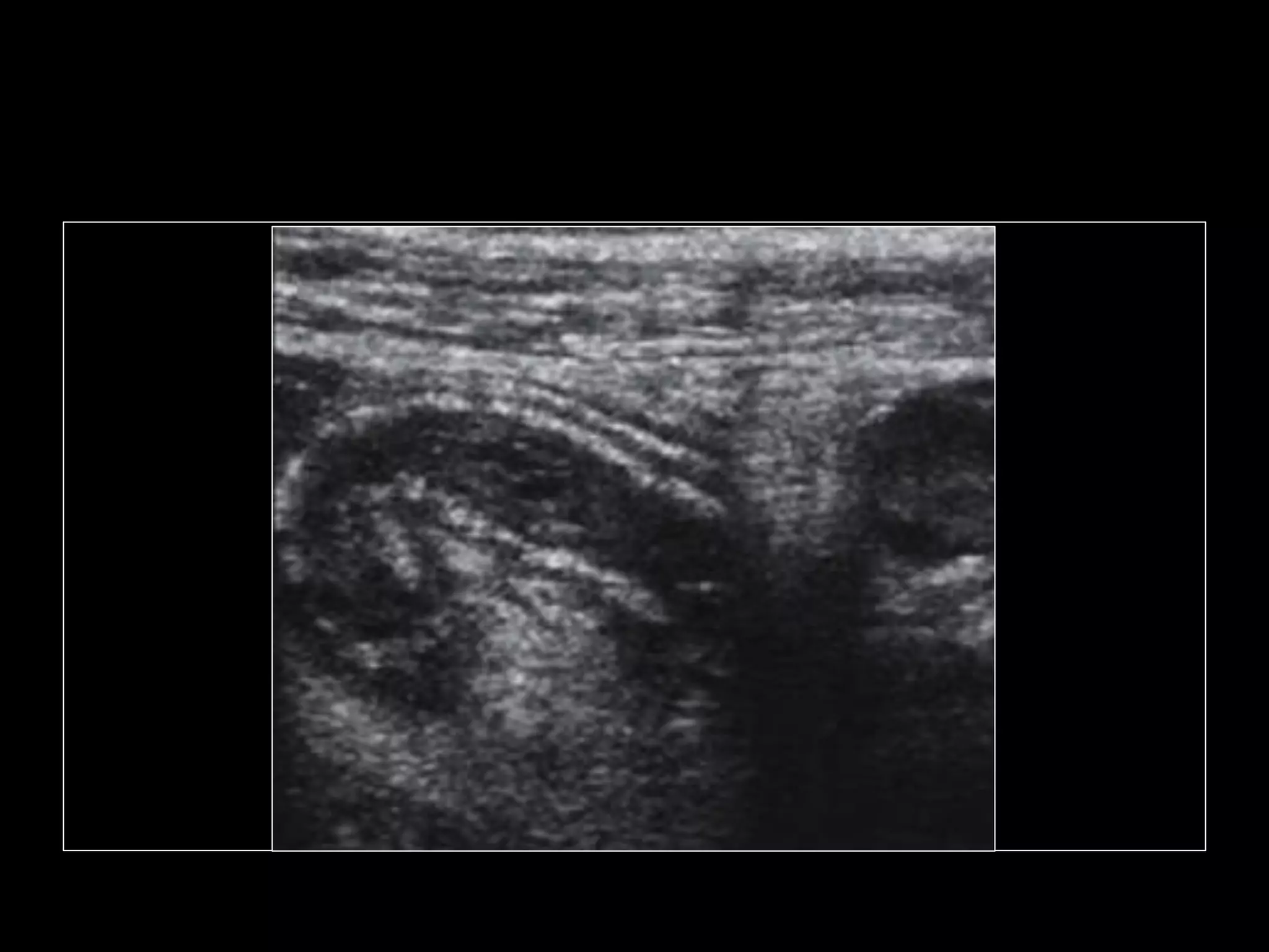 Emergency Ultrasound Course -Lecture 04 -Acute Appendicitis -Part 2 | PDF