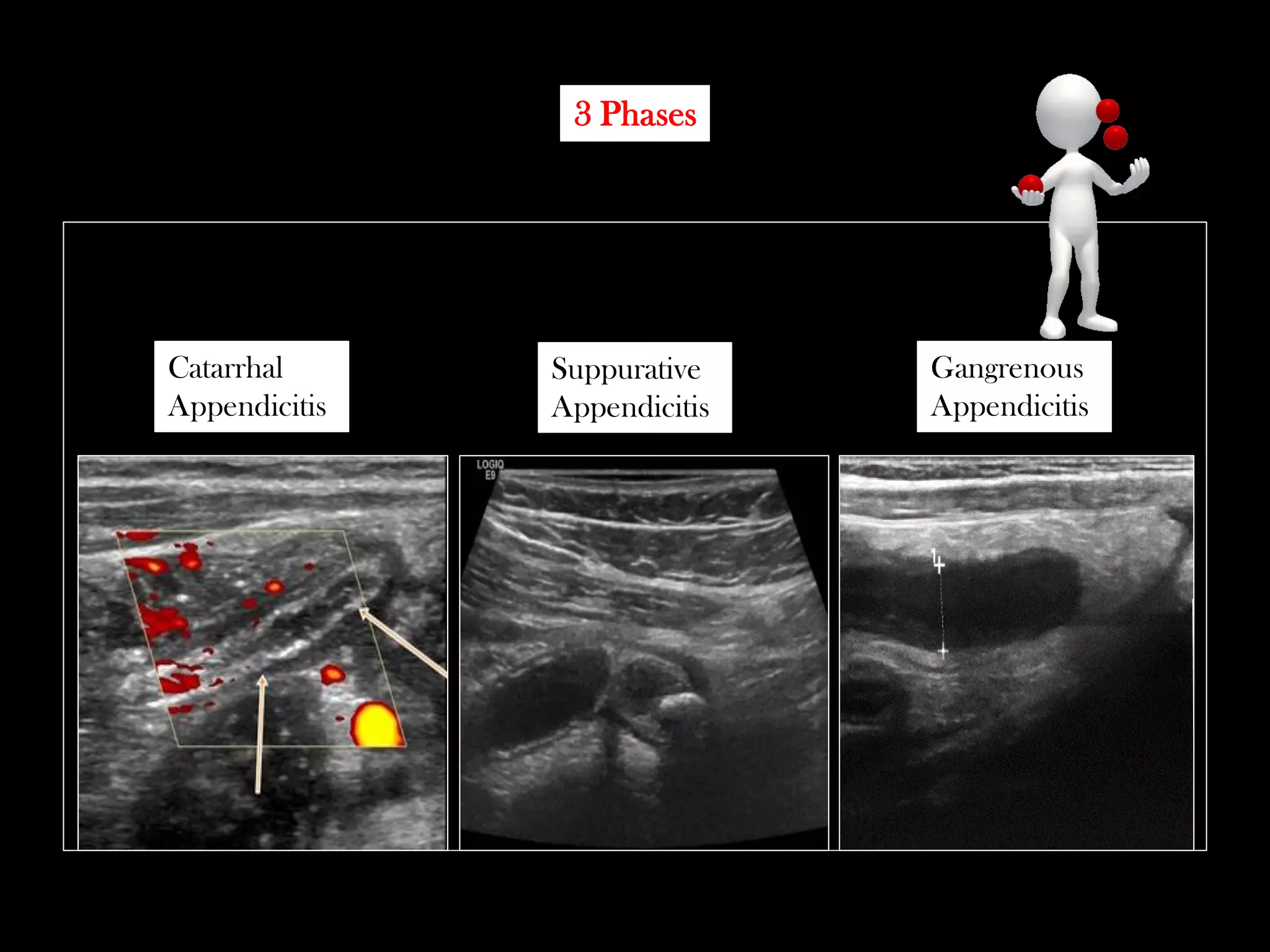 Emergency Ultrasound Course -Lecture 04 -Acute Appendicitis -Part 2 | PDF