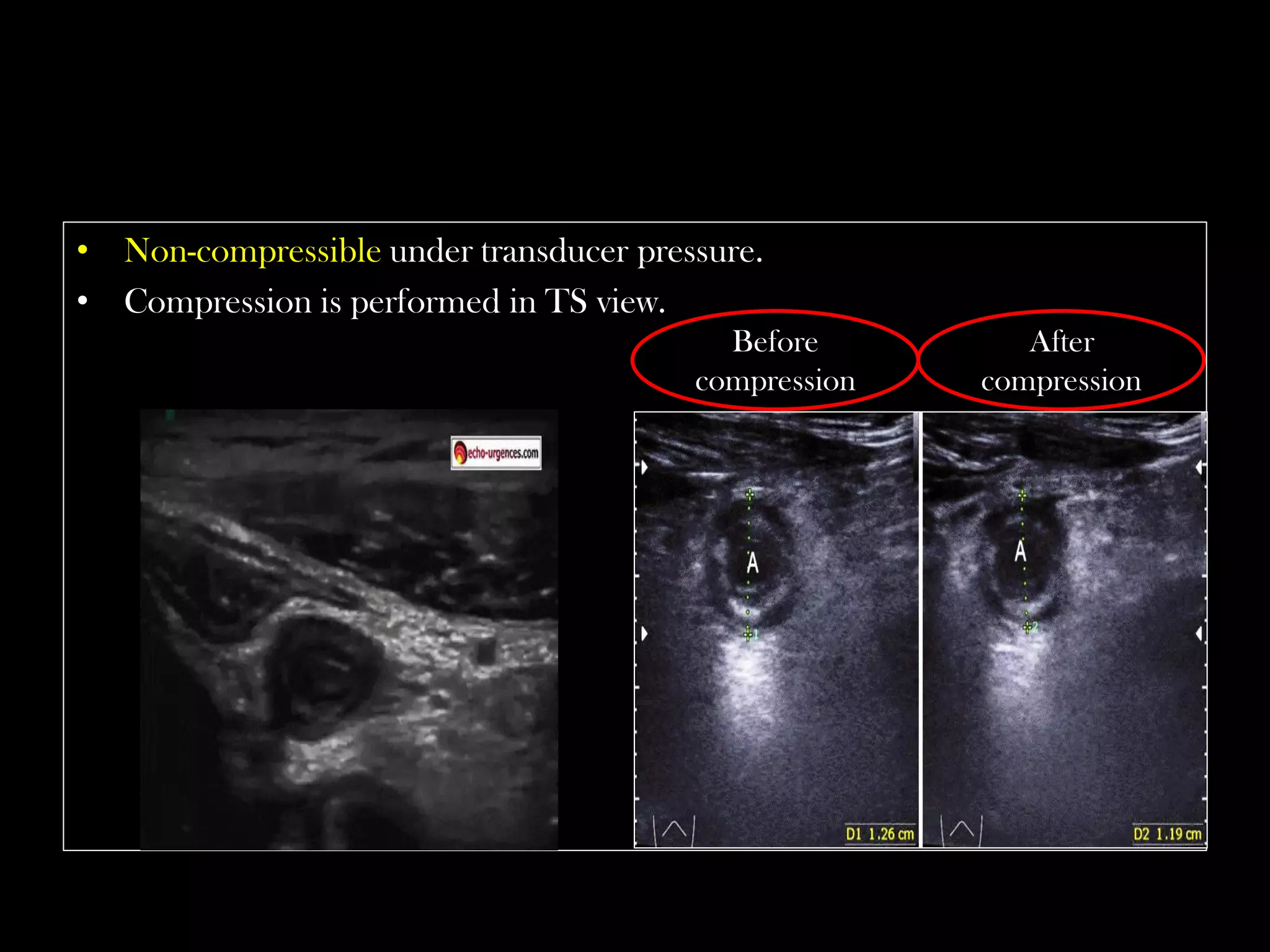 Emergency Ultrasound Course -Lecture 04 -Acute Appendicitis -Part 2 | PDF