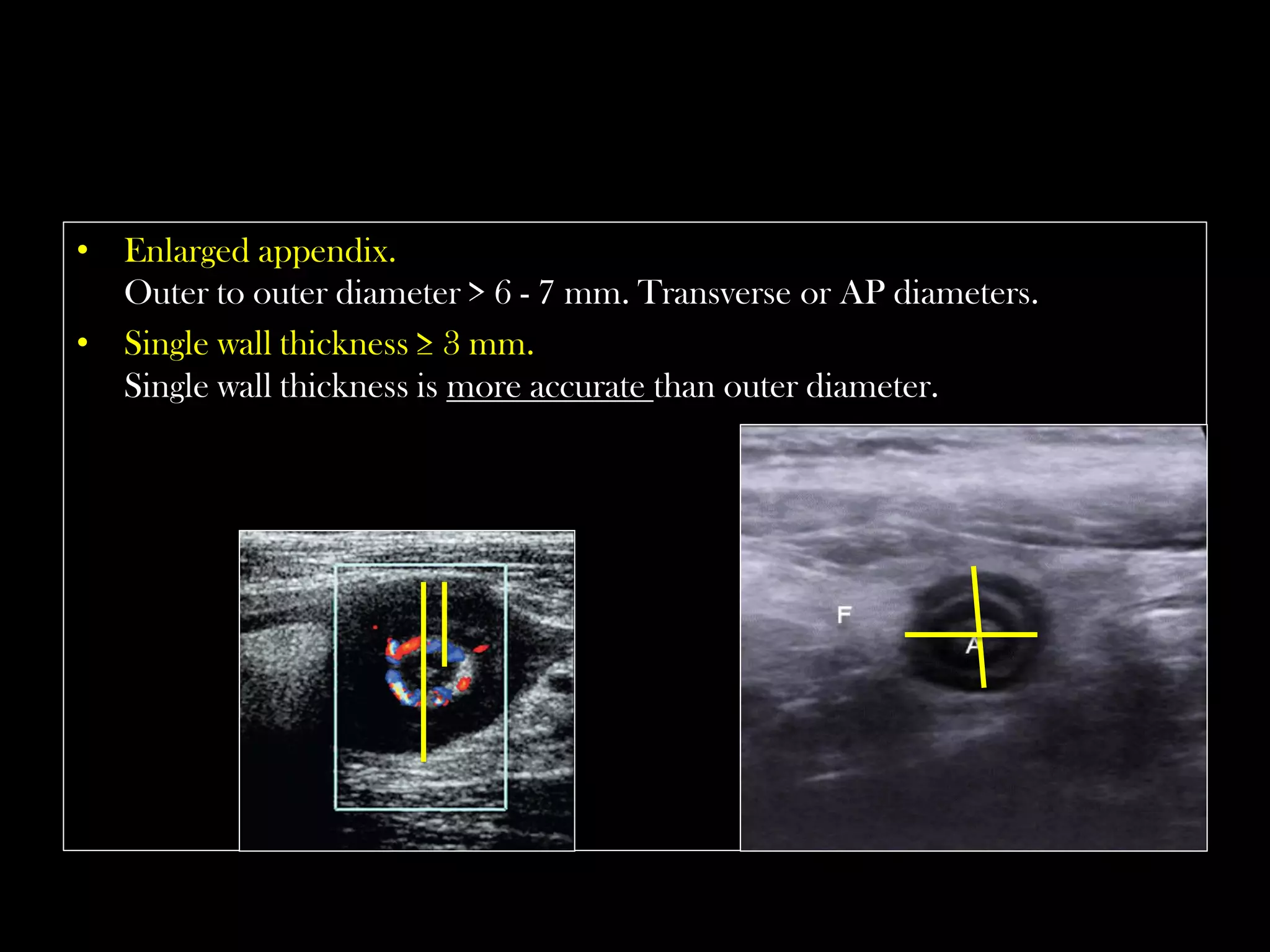 Emergency Ultrasound Course -Lecture 04 -Acute Appendicitis -Part 2 | PDF