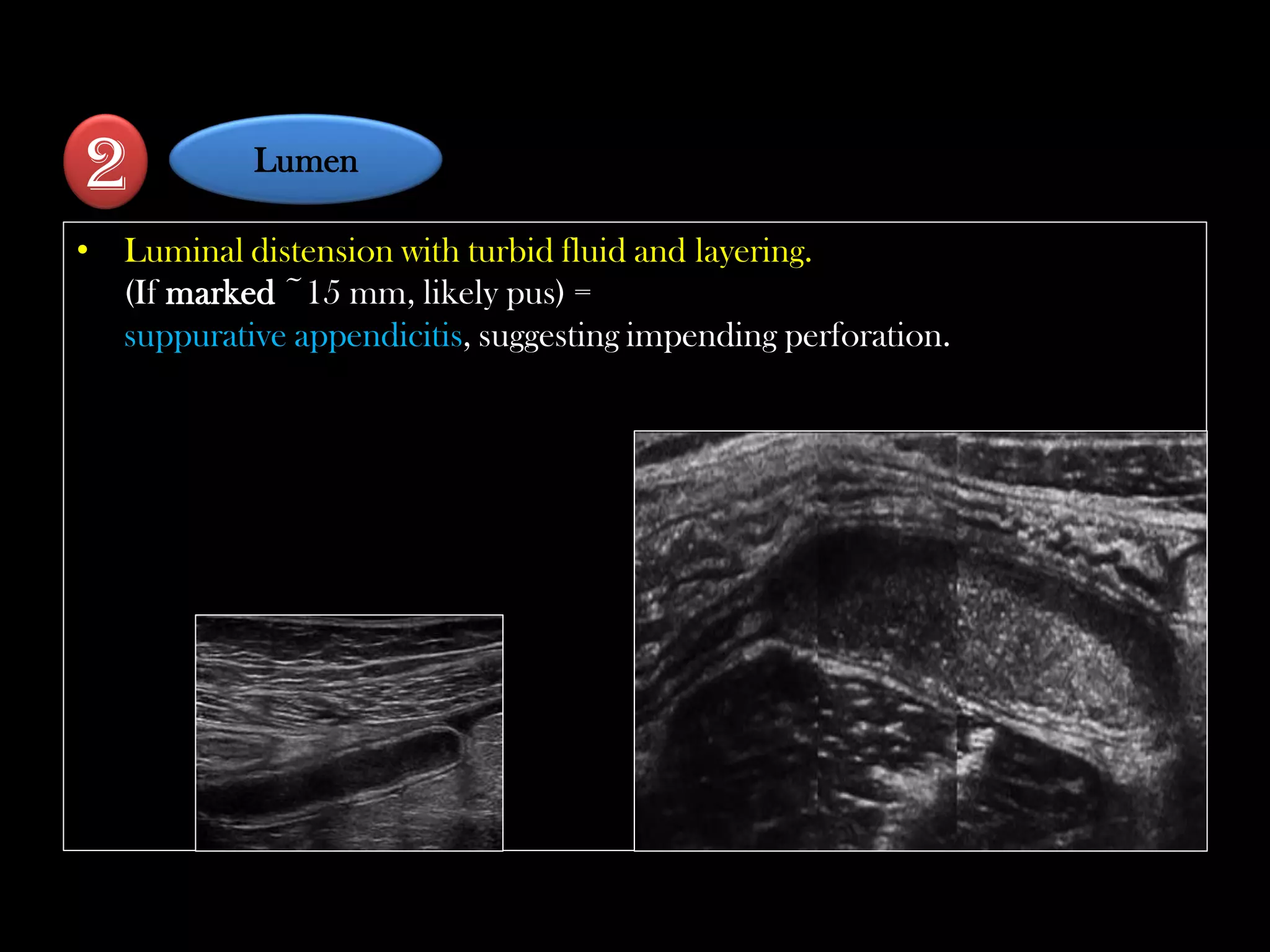 Emergency Ultrasound Course -Lecture 04 -Acute Appendicitis -Part 2 | PDF