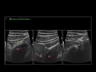 Emergency Ultrasound Course -Lecture 04 -Acute Appendicitis -Part 2 | PDF
