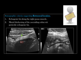 Emergency Ultrasound Course -Lecture 04 -Acute Appendicitis -Part 2 | PDF