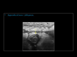 Emergency Ultrasound Course -Lecture 04 -Acute Appendicitis -Part 2 | PDF