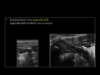 Appendicolith Ultrasound