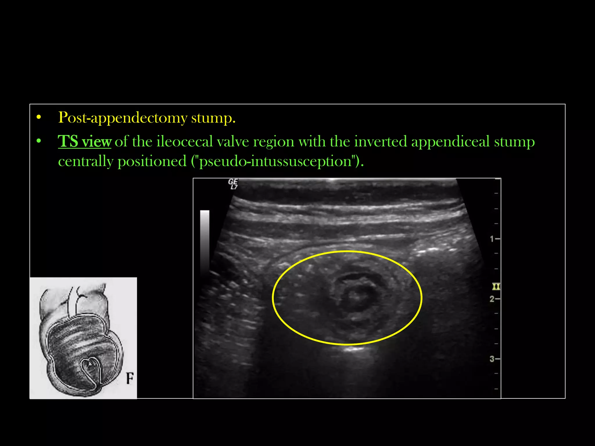 Emergency Ultrasound Course -Lecture 04 -Acute Appendicitis -Part 3 | PDF
