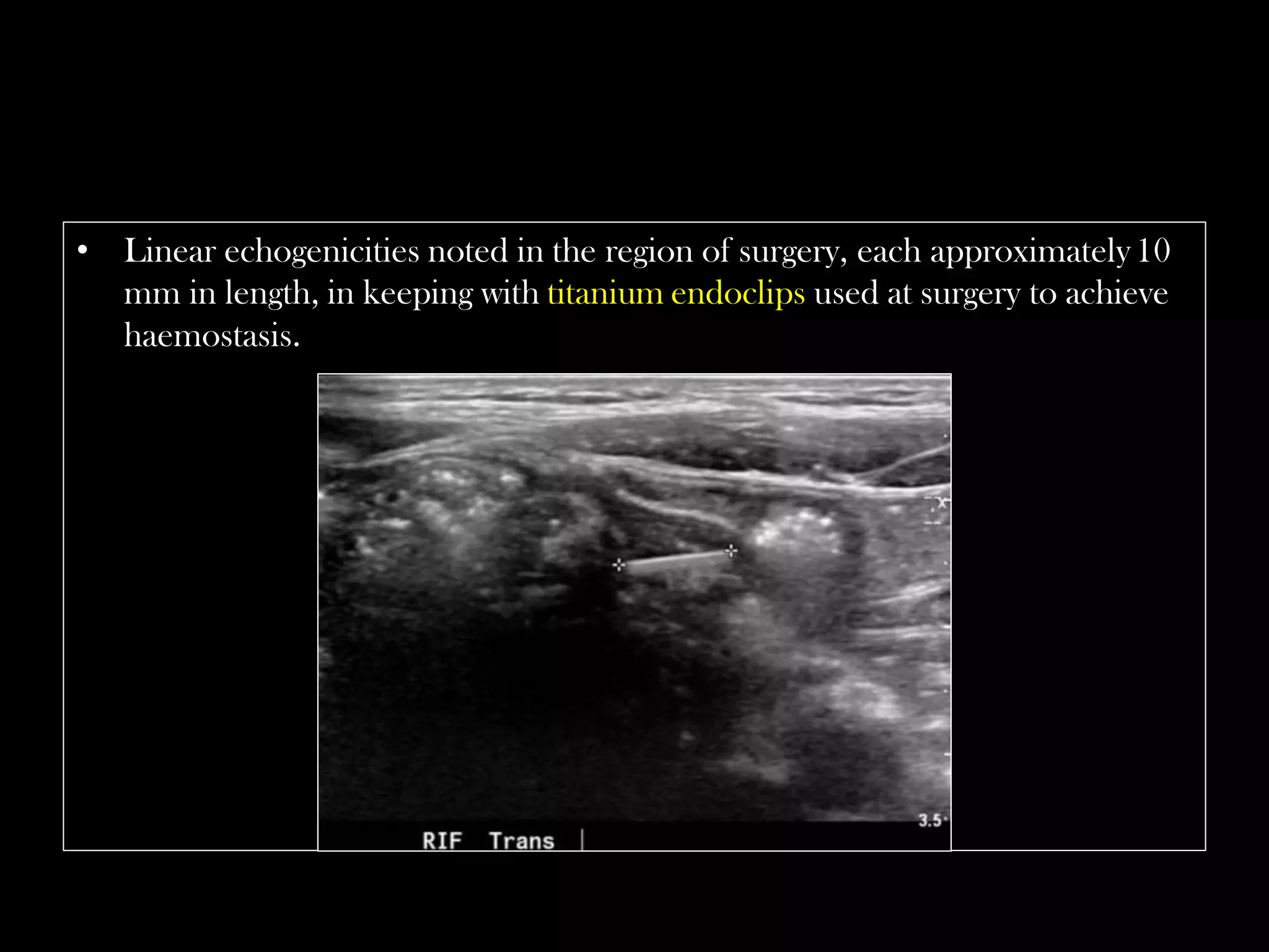 Emergency Ultrasound Course -Lecture 04 -Acute Appendicitis -Part 3 | PDF