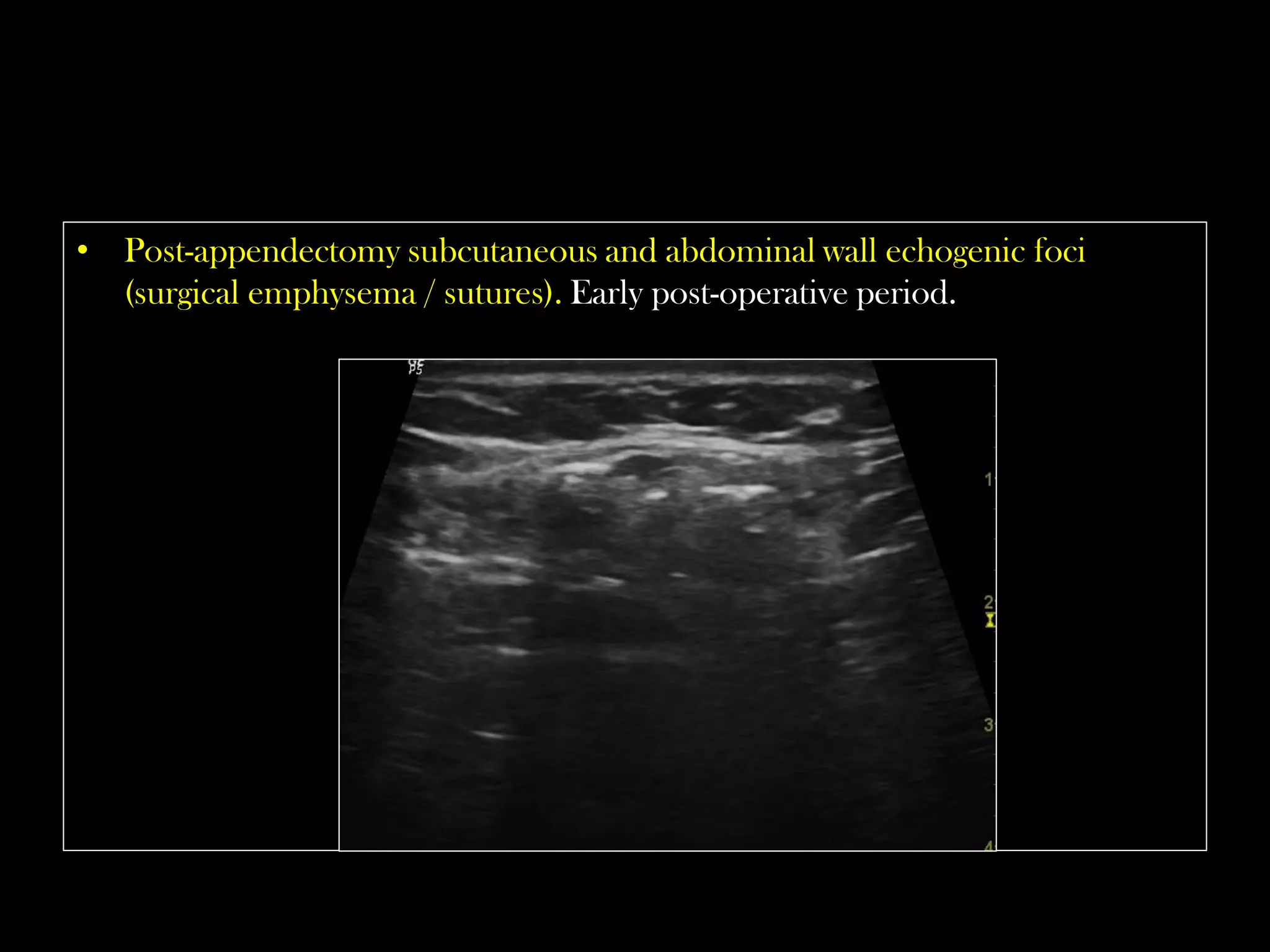 Emergency Ultrasound Course -Lecture 04 -Acute Appendicitis -Part 3 | PDF