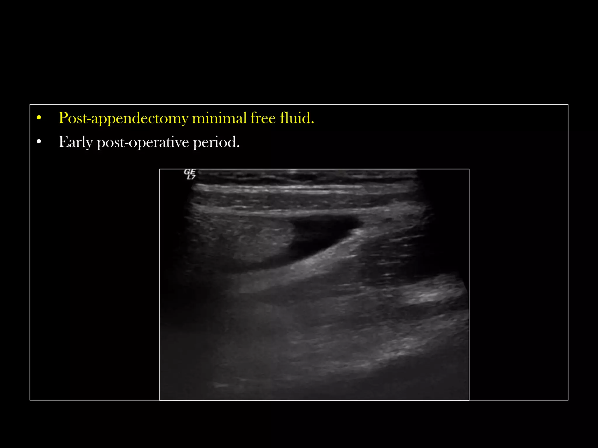 Emergency Ultrasound Course -Lecture 04 -Acute Appendicitis -Part 3 | PDF