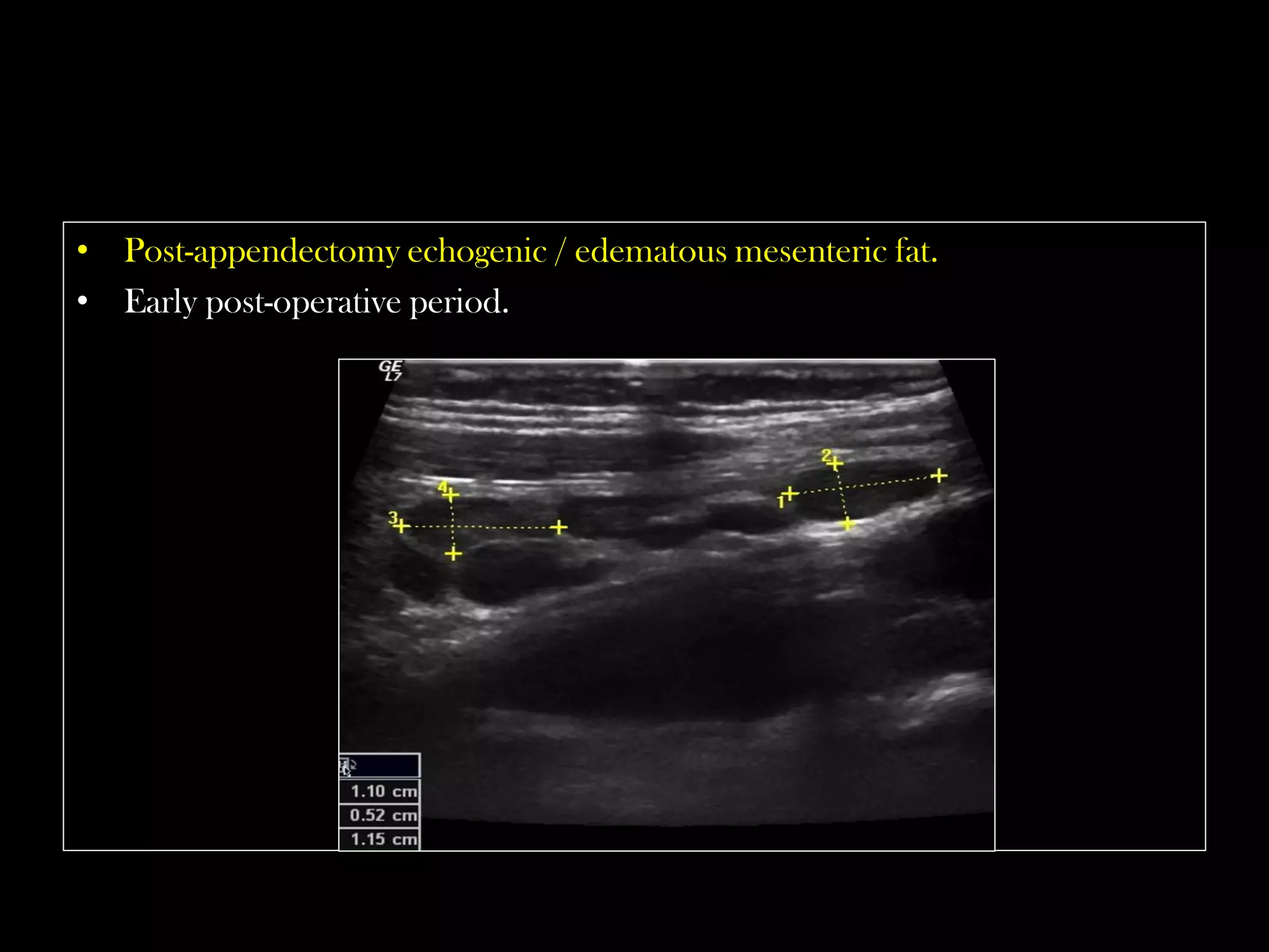 Emergency Ultrasound Course -Lecture 04 -Acute Appendicitis -Part 3 | PDF