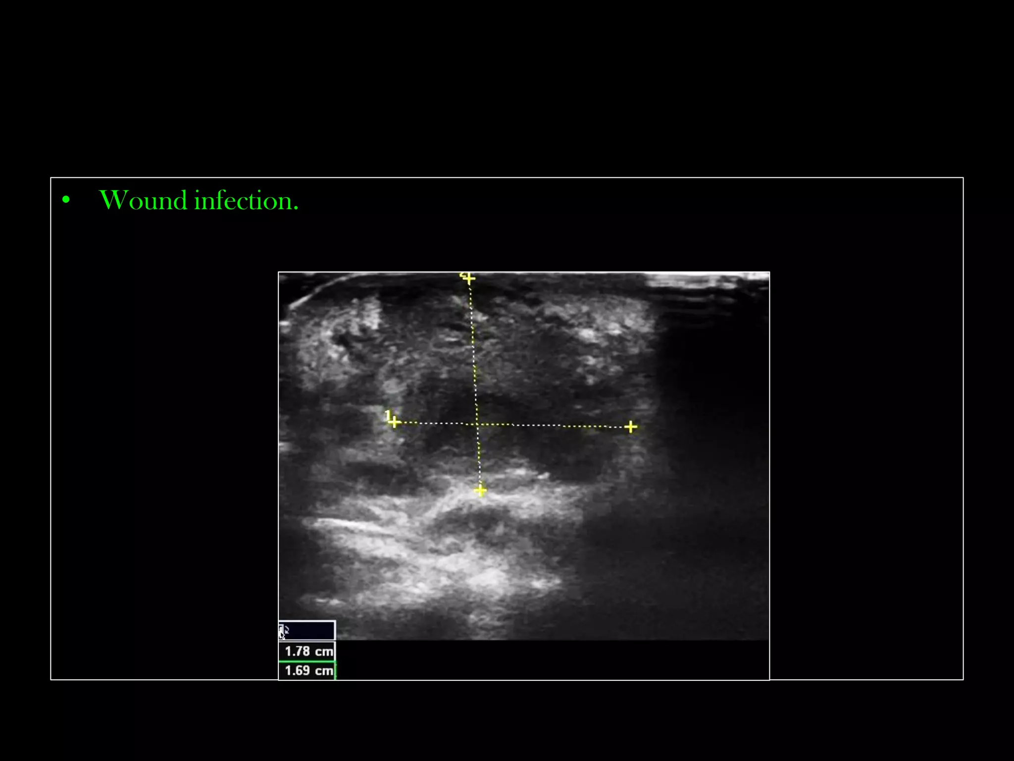 Emergency Ultrasound Course -Lecture 04 -Acute Appendicitis -Part 3 | PDF