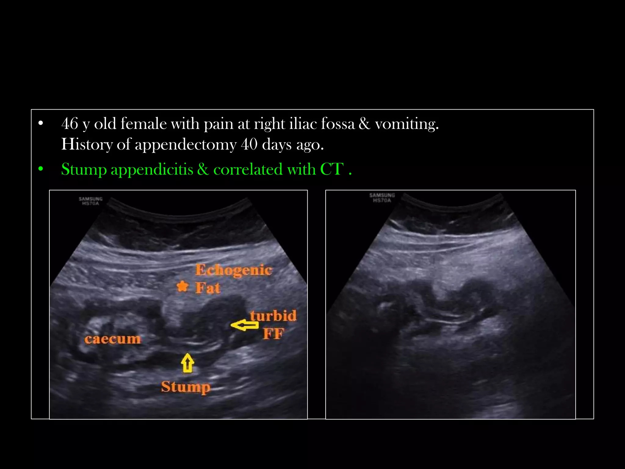 Emergency Ultrasound Course -Lecture 04 -Acute Appendicitis -Part 3 | PDF