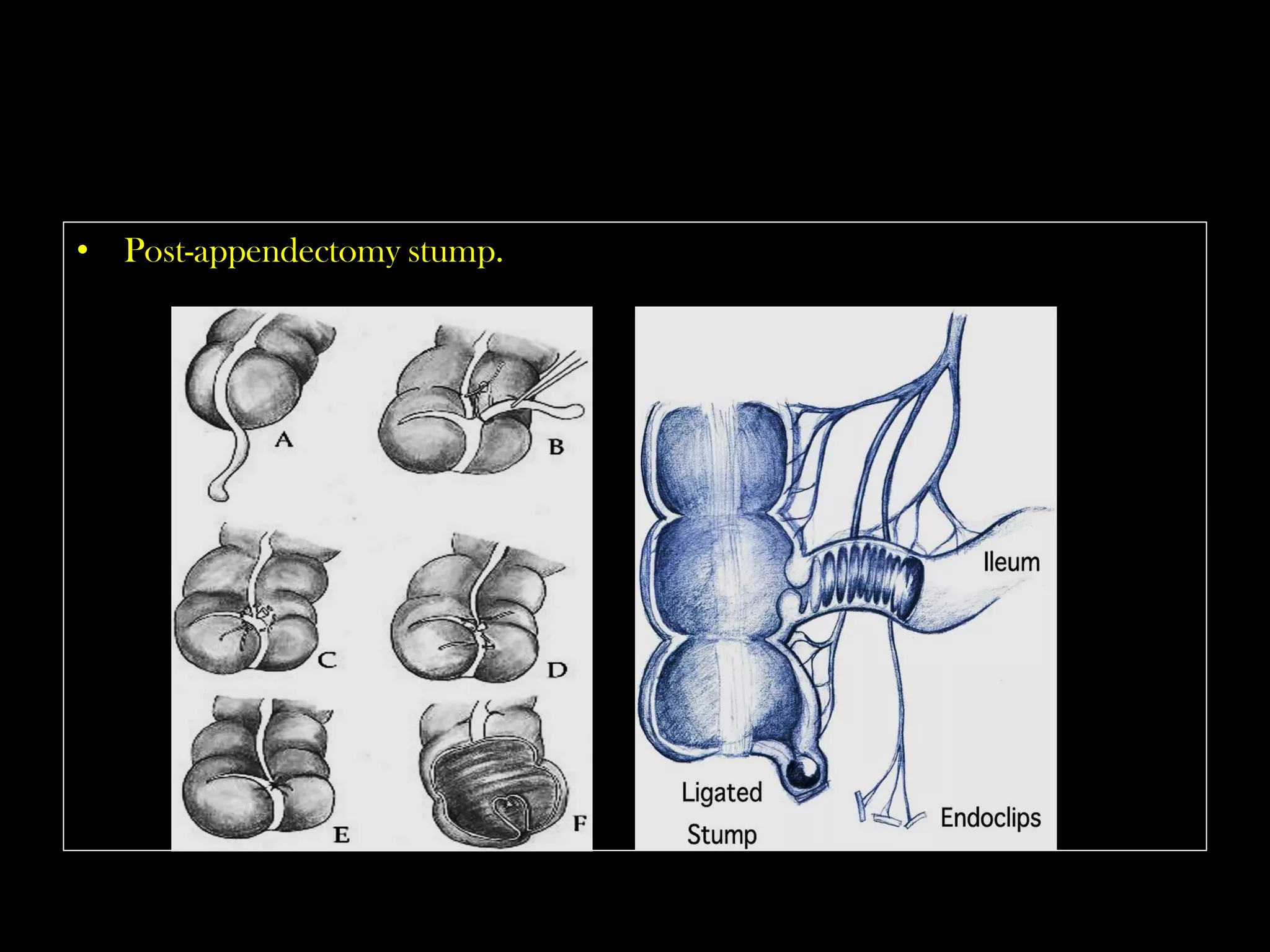 Emergency Ultrasound Course -Lecture 04 -Acute Appendicitis -Part 3 | PDF