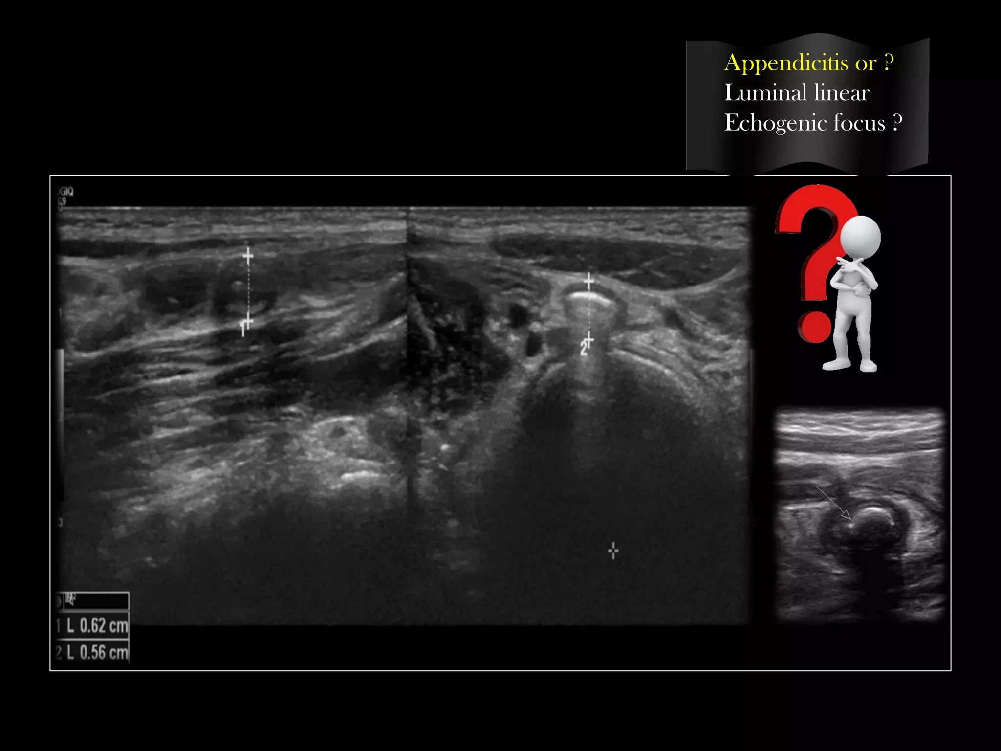 Emergency Ultrasound Course -Lecture 04 -Acute Appendicitis -Part 3 | PDF
