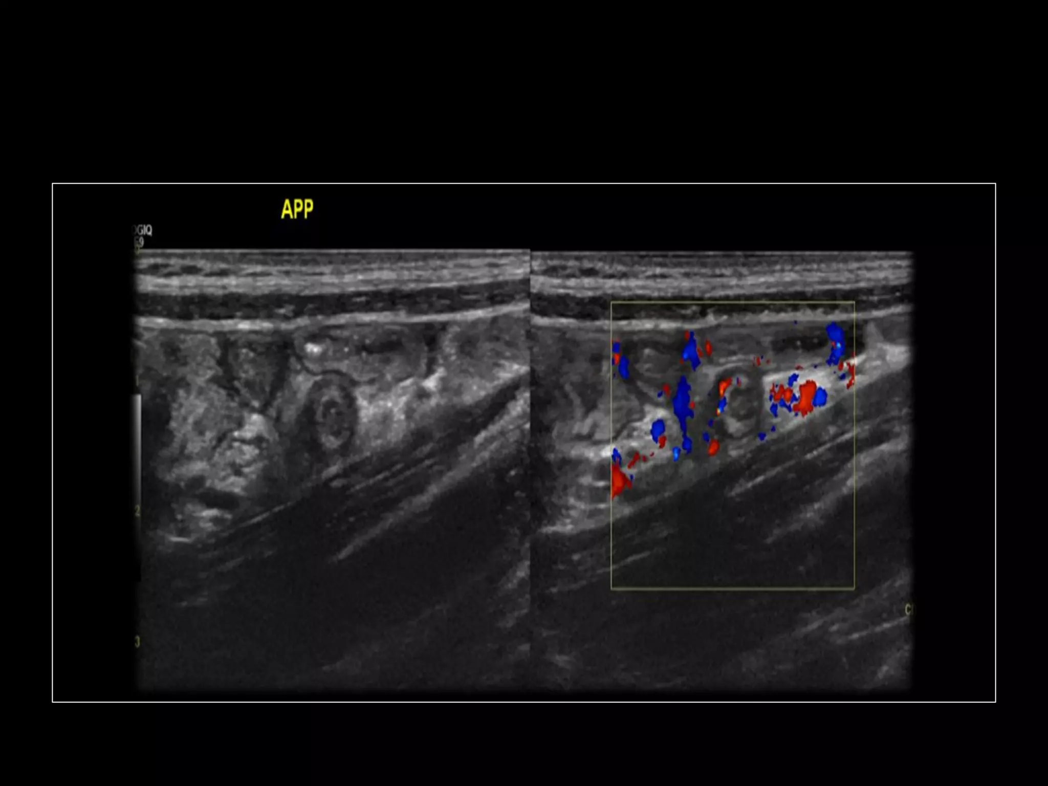 Emergency Ultrasound Course -Lecture 04 -Acute Appendicitis -Part 3 | PDF