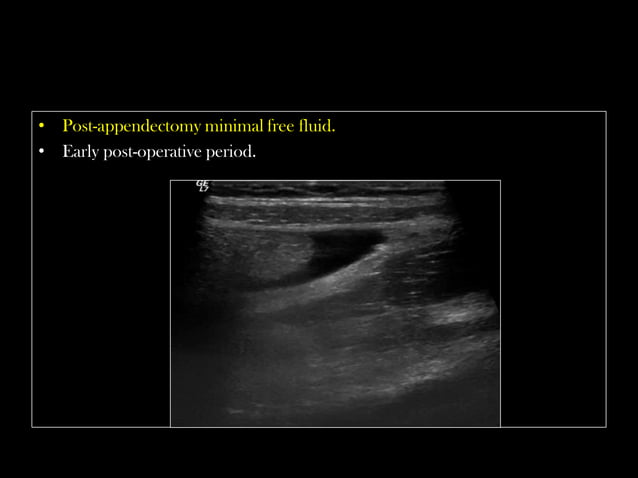 Emergency Ultrasound Course -Lecture 04 -Acute Appendicitis -Part 3 ...