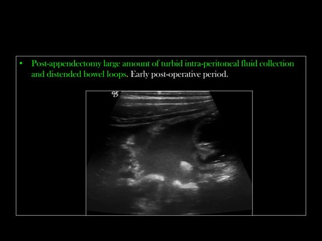 Emergency Ultrasound Course -Lecture 04 -Acute Appendicitis -Part 3 ...